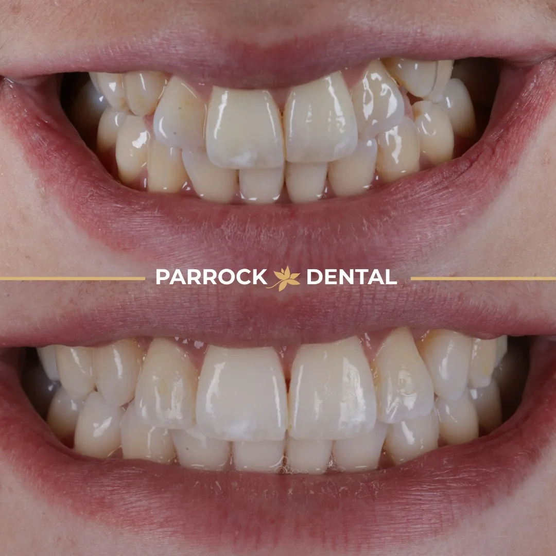Invisalign Kent Gravesend | Invisalign Clear Braces in Kent